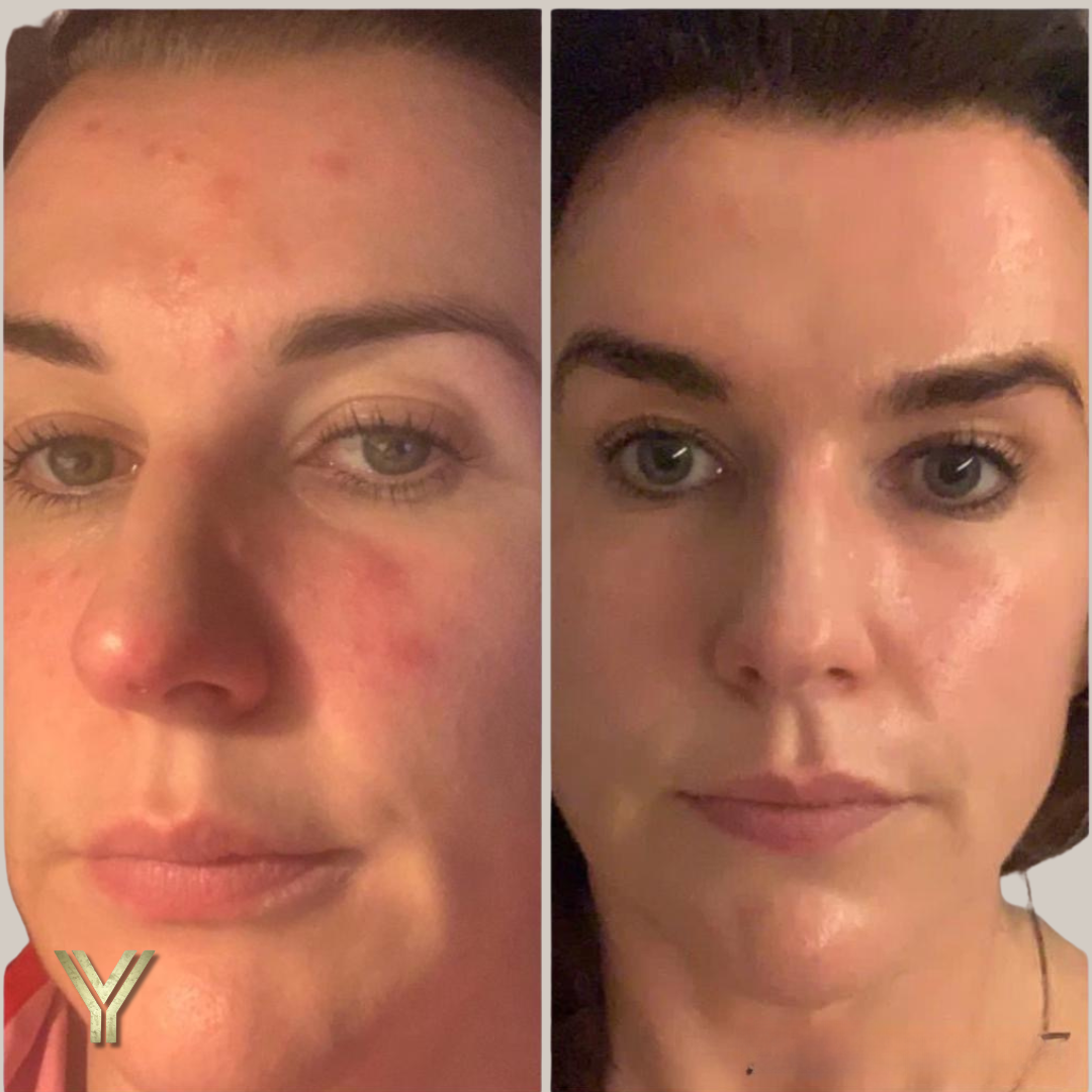TriBella - Full Facial Rejuvenation – Younique Aesthetics